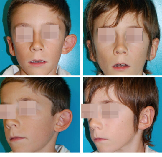 Otoplastie - Chirurgie des oreilles à Lausanne, Montreux, Genève