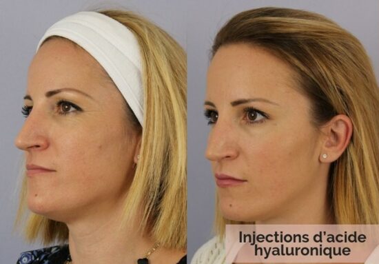 Injections d'acide hyaluronique - The Beauty Suite - lausanne